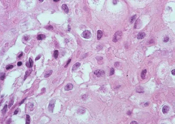 Smallpox vials discovered: Smallpox and related pox viruses could still ...