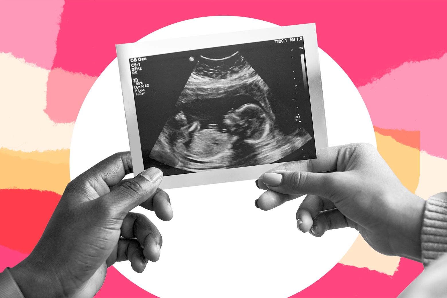 Parenting advice: How to handle one spouse's gender disappointment.