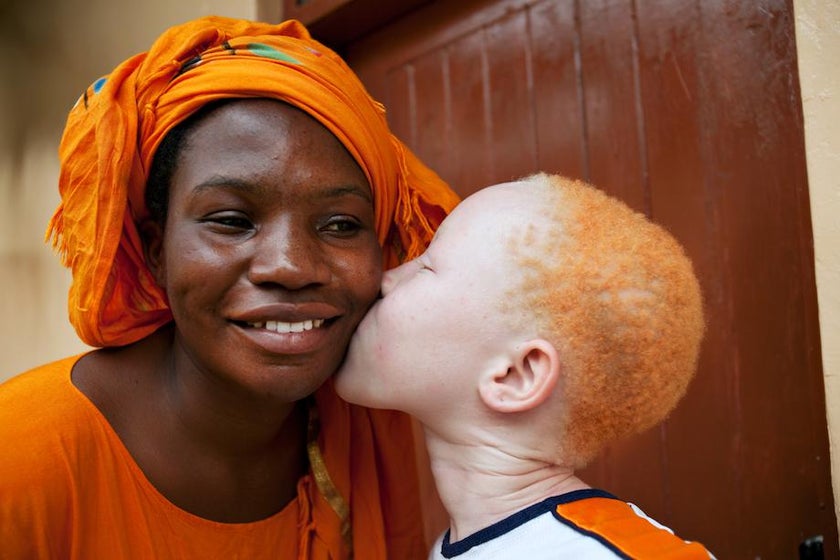 Liron Shimoni photographs albinos in Tanzania in his series, “White ...