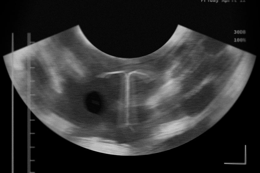 Pregnancy with an IUD is possible, and Roe overturn could make it more ...