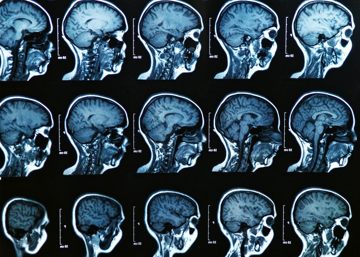 Does testosterone therapy affect the brain?